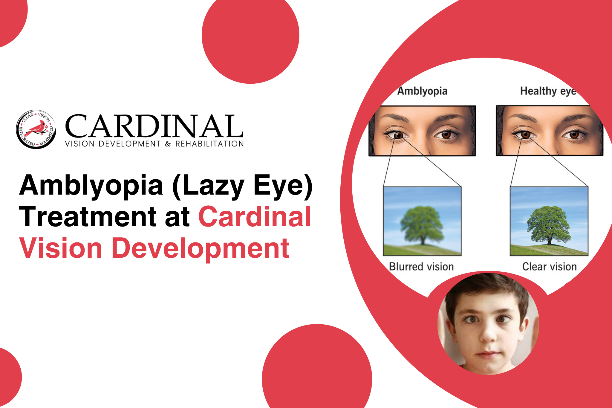 Amblyopia (Lazy Eye) Treatment Guide | Blog